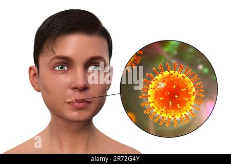 Cold sore on the lip of a teenage boy and closeup view of herpes ...