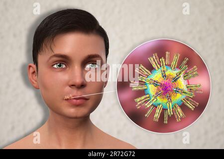 Cold sore on the lip of a teenage boy and closeup view of herpes ...