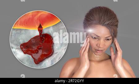 Haemorrhagic stroke, computer illustration showing a person with ...