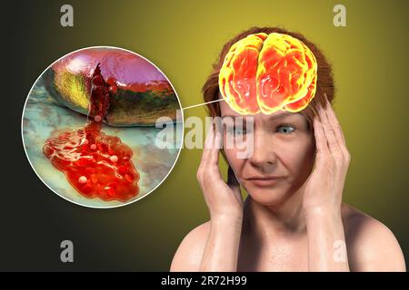 Haemorrhagic stroke. Illustration of a ruptured blood vessel in the ...
