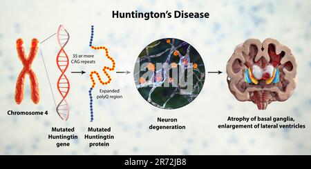 Molecular genesis of Huntington's disease, computer illustration ...