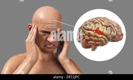 Haemorrhagic stroke, computer illustration showing a person with ...