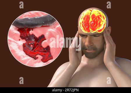 Haemorrhagic stroke. Illustration of a ruptured blood vessel in the ...