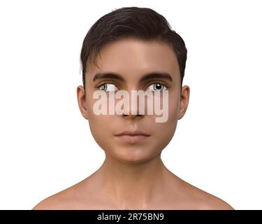 Illustration of exotropia, a form of strabismus where one or both eyes ...