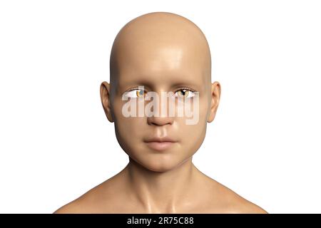 Illustration of esotropia, a form of strabismus where one or both eyes ...
