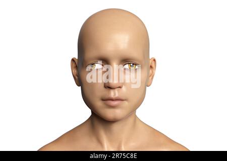 Illustration of exotropia, a form of strabismus where one or both eyes ...