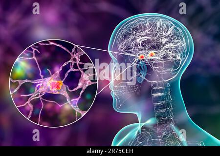 Amygdala in the brain, and closeup view of amygdala neurons, computer ...