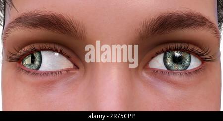 Illustration of exotropia, a form of strabismus where one or both eyes ...