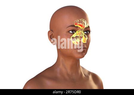 Sinus anatomy, computer illustration. The sinuses are membrane-lined ...