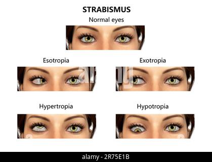 Types of strabismus. Eyes with esotropia, exotropia, hypertropia and ...