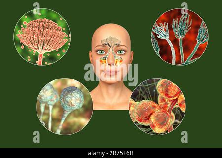 Aspergillus fungi as a cause of sinusitis. Computer illustration ...