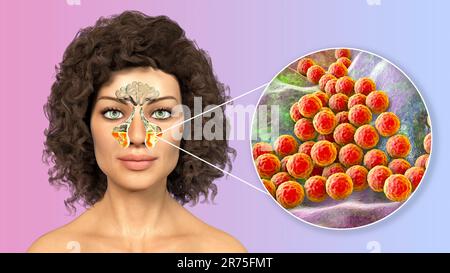Staphylococcus aureus bacteria as a cause of sinusitis. Computer ...