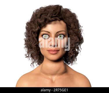 Goitre. Artwork of an enlarged thyroid gland (goitre). The normal size ...