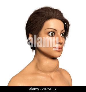 Thyrotoxic goitre (goitre), illustration. Goitre (swollen neck) seen on ...