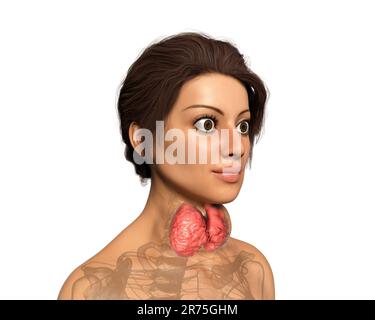Thyrotoxic goitre (goitre), illustration. Goitre (swollen neck) seen on ...