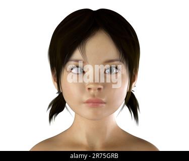 Illustration of esotropia, a form of strabismus where one or both eyes ...