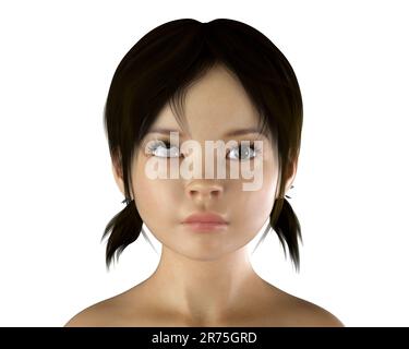 Illustration of hypertropia, a form of vertical strabismus where there ...
