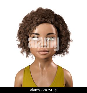 Illustration of hypertropia, a form of vertical strabismus where there ...