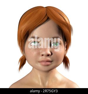 Illustration of hypertropia, a form of vertical strabismus where there ...