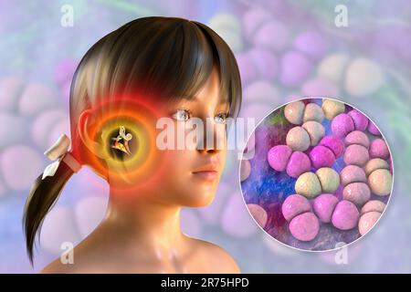 Otitis media ear infection caused by Moraxella catarrhalis bacteria ...