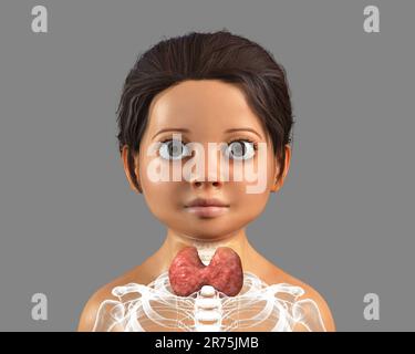 Thyrotoxic goitre (goitre), illustration. Goitre (swollen neck) seen on ...