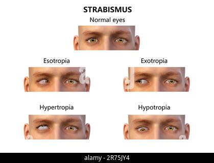 Strabismus types, computer illustration Stock Photo - Alamy