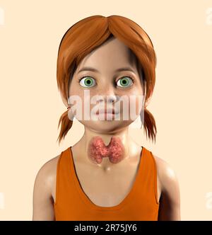 Thyrotoxic goitre (goitre), illustration. Goitre (swollen neck) seen on ...