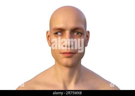 Illustration of exotropia, a form of strabismus where one or both eyes ...