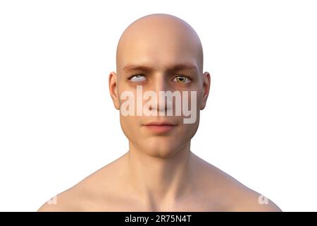 Illustration of hypertropia, a form of vertical strabismus where there ...