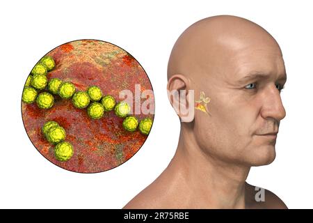 Otitis media ear infection caused by Streptococcus pyogenes bacteria ...