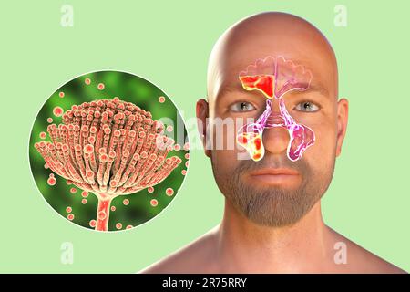 Fungi as a cause of sinusitis. Computer illustration showing ...