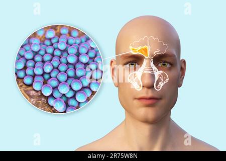 Staphylococcus aureus bacteria as a cause of sinusitis. Computer ...