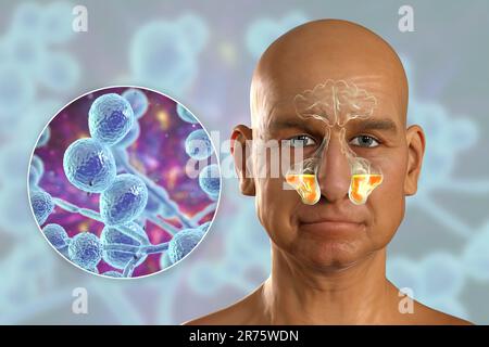 Candida yeast fungi as a cause of sinusitis. Computer illustration ...