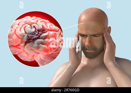 Haemorrhagic stroke. Illustration of a ruptured blood vessel in the ...