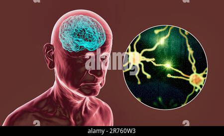 Dementia, conceptual computer illustration showing an elderly person ...