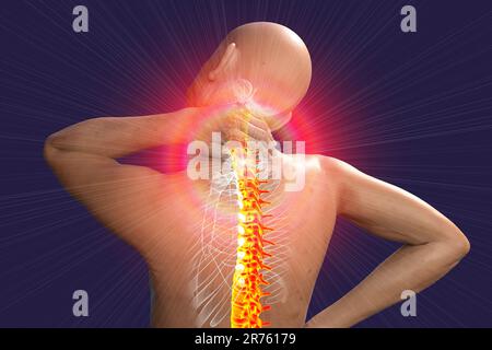 Human neck pain, computer artwork Stock Photo - Alamy