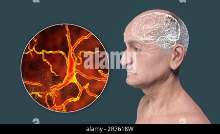 Dementia, conceptual computer illustration showing an elderly person ...