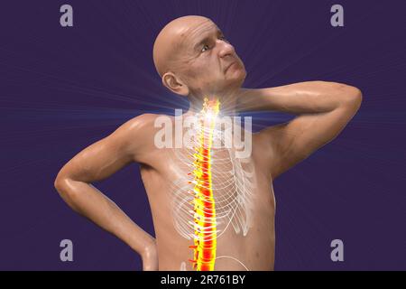 Human neck pain, computer artwork Stock Photo - Alamy