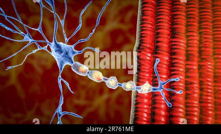 Demyelinated nerve in multiple sclerosis (MS). Transmission electron ...