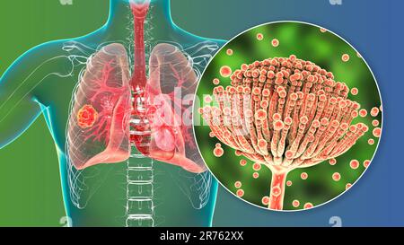 Pulmonary aspergillosis, invasion of a lung tissue by mold fungi ...