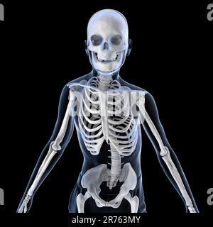 Scoliosis in children, computer illustration. A child with curved spine ...