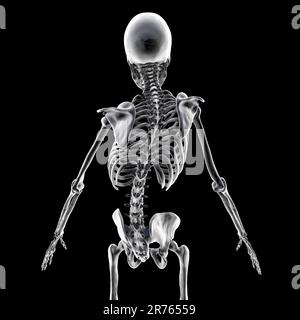 Scoliosis in children, computer illustration. A child with curved spine ...