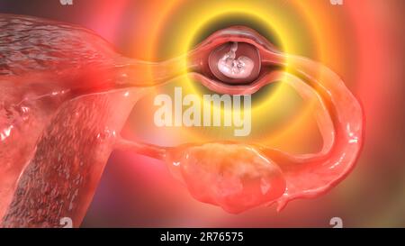 Ectopic pregnancy, illustration. The embryo has implanted in the ...