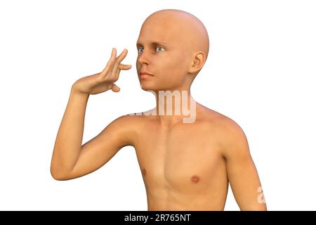A boy with Sydenham's chorea and involuntary movements of a hand ...