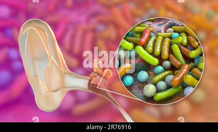 Otitis media ear infection and closeup view of bacteria, the ...