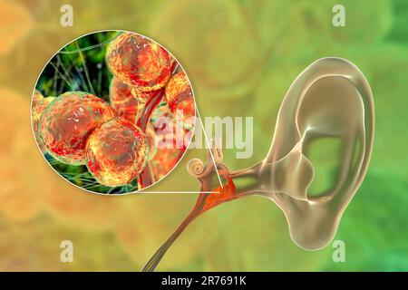 Chronic fungal otitis media ear infection. Computer illustration ...