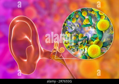 Otitis media ear infection and closeup view of bacteria, the ...