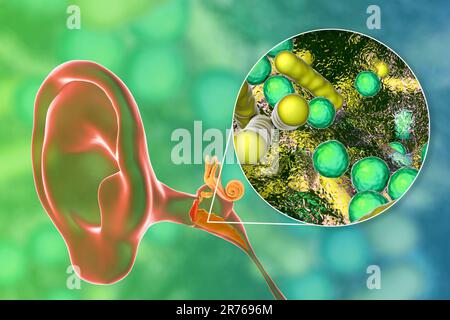 Otitis media ear infection and closeup view of bacteria, the ...