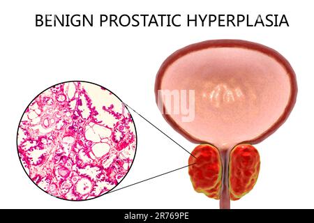 Light micrograph (left) and computer illustration (right) showing ...