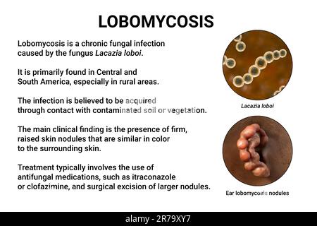 Lobomycosis, a chronic skin disease caused by microscopic fungi Lacazia ...